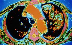 Triple therapy 'potentially best option' for stable COPD patients ...