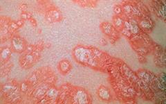 Cosentyx: a new option in plaque psoriasis | MIMS online