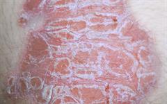 Psoriasis treatment secukinumab approved by NICE | MIMS online