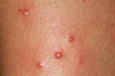 Pustules and irritation: Pictorial case study | GPonline