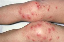 Acute skin problems in children | GPonline