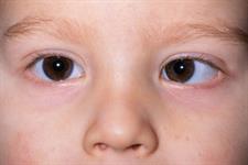 The basics - Strabismus | GPonline