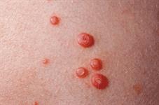 Pictorial case study - Papules on a child | GPonline