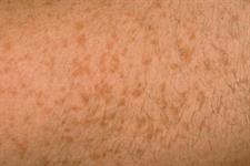 Case study - A transient purpuric rash with vomiting | GPonline