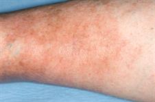 Treating patients with venous disease | GPonline