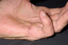 Illustrated: Conditions affecting hands | GPonline