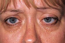 Expert Opinion - Diagnosing thyroid eye disease | GPonline