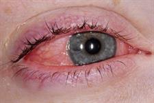 Practice dilemma - A prescription for steroid eye drops | GPonline