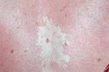 Skin pigmentation conditions | GPonline