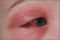 At a Glance - Orbital cellulitis vs periorbital cellulitis | GPonline