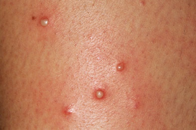Pustules and irritation: Pictorial case study | GPonline