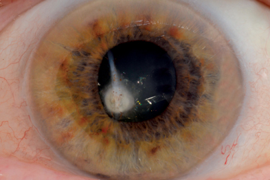 Clinical pictures: Eye problems | GPonline