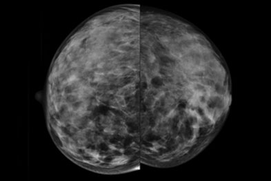 Clinical Review: Breast cancer | GPonline