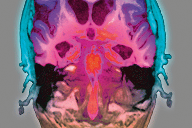 Brain shrinkage in Alzheimer's seen years before symptoms | GPonline