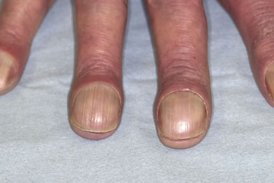 Clinical images: Nails | GPonline