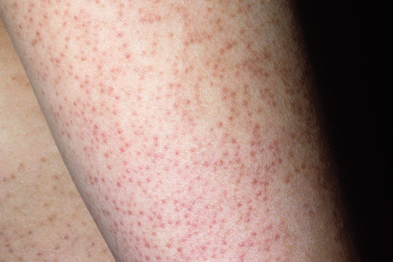 Troublesome rough skin | GPonline