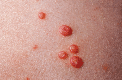 Pictorial case study - Papules on a child | GPonline