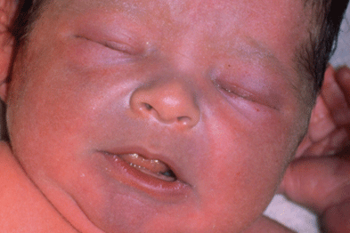 The Basics - Managing croup | GPonline