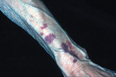 Illustrated: Skin changes with age | GPonline