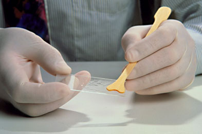 'Jade Goody effect' helps increase cervical cancer screening rates ...