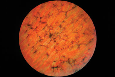 Rare diseases: Retinitis pigmentosa | GPonline