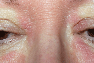 Skin conditions: before and after | GPonline