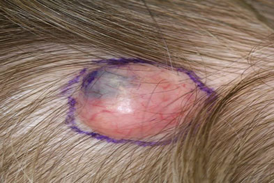 Pictorial Case Study - A nodular scalp lesion | GPonline