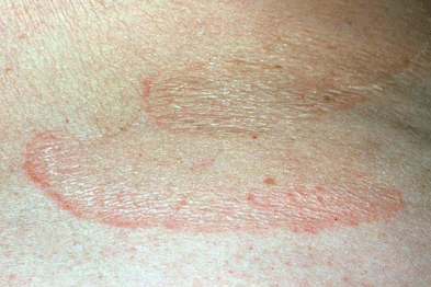 At a Glance - Erythema annulare centrifugum versus Lyme disease | GPonline