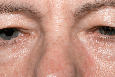 Case Study - An unusual case of unequal pupils | GPonline