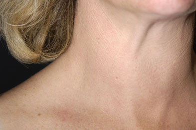 The basics - Hyperthyroidism | GPonline