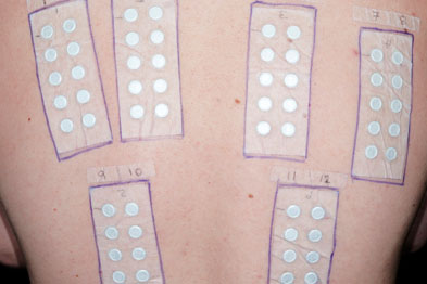Patch testing essential for allergic children | GPonline