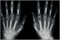 NICE guidelines for rheumatoid arthritis | GPonline