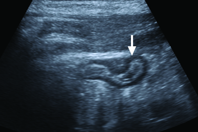 Clinical Review: Acute appendicitis | GPonline