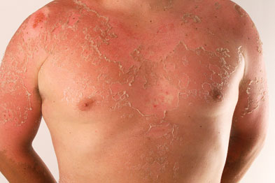 The management of sunburn | GPonline
