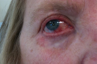 Meibomian gland dysfunction | GPonline