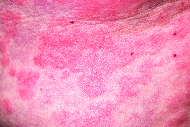 Improve your knowledge of skin conditions with new articles from MIMS ...