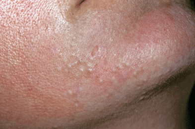 Facial lumps and bumps | GPonline