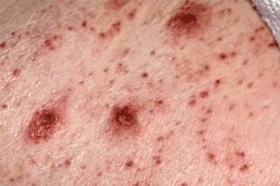 Pictorial case study: Itchy rash | GPonline