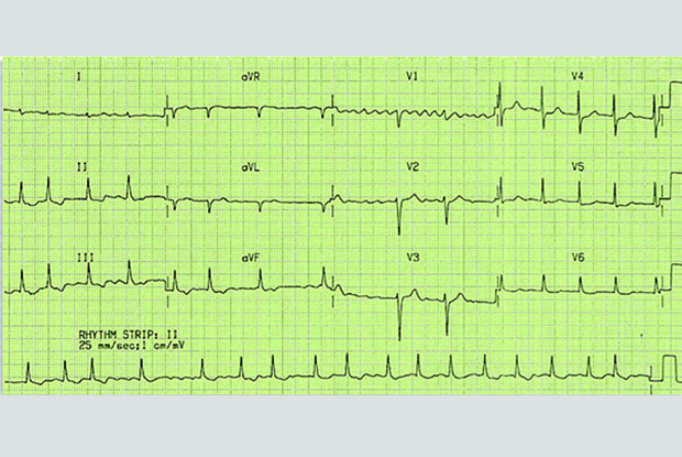 Clinical review: Atrial fibrillation | GPonline