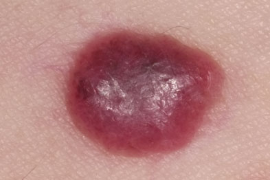 Clinical images - Nodular skin lesions | GPonline