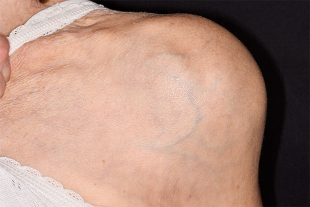 Shoulder problems: illustrated | GPonline