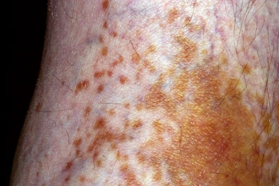 Differential diagnoses - Pigment formation | GPonline