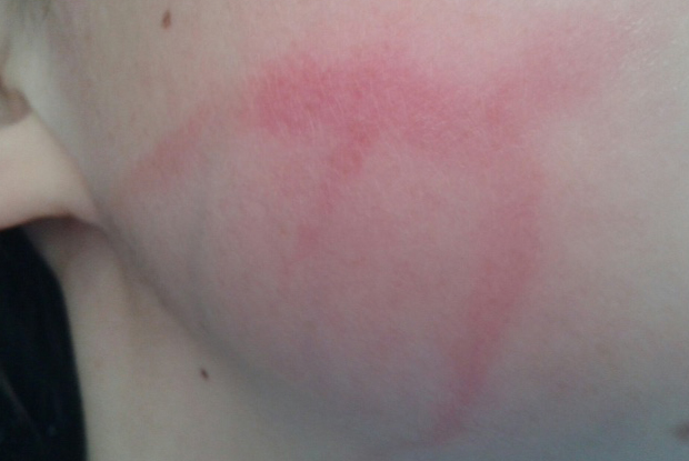 Facial Raynaud's disease: case study | GPonline