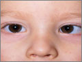 Paediatric medicine - Child presenting with strabismus | GPonline