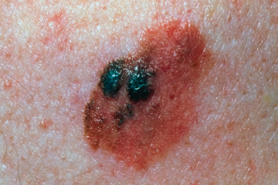 Pictorial case study - Concern about changes to a mole | GPonline