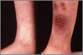 Pictorial Case Study: Pyoderma gangrenosum | GPonline