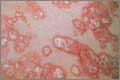 Pictorial case study: Psoriasis | GPonline