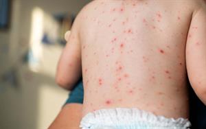 Chickenpox vaccination could be added to routine schedule from 2026 ...