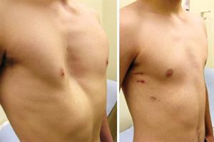 Thoracic medicine - Anterior chest wall deformities | GPonline