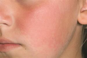 Pictorial case study: A child with red cheeks | GPonline